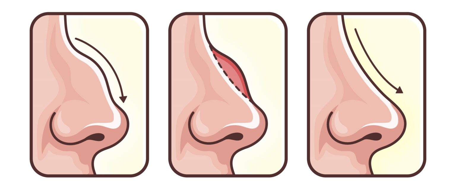 #1 Why Rhinoplasty in Turkey Has Become the Top Choice for Patients ...